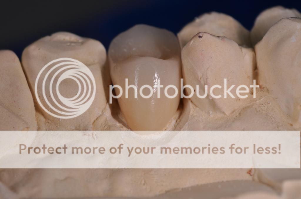 3Shape anatomical cut back help | Dental Lab Network