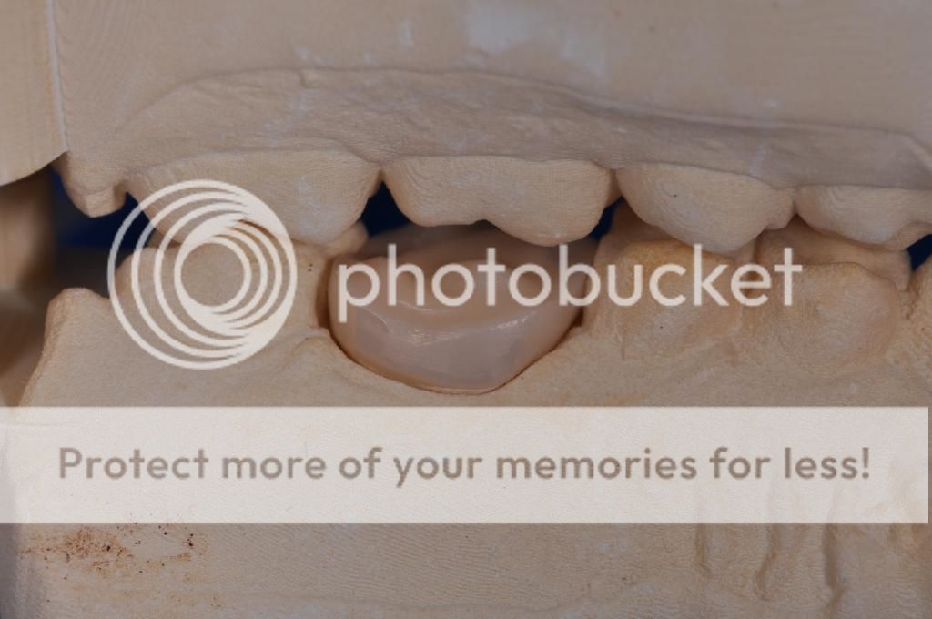 3Shape anatomical cut back help | Dental Lab Network