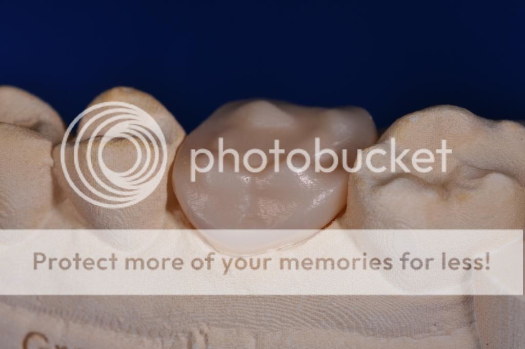 3Shape anatomical cut back help | Dental Lab Network